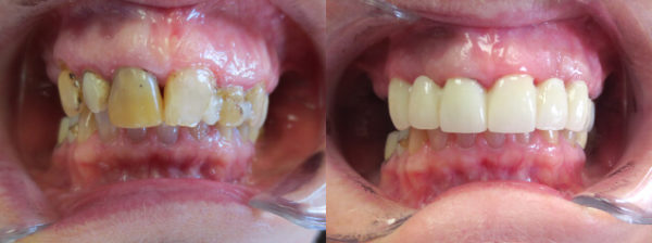 6-unit Porcelain Bridge - Chester Mendham Dental