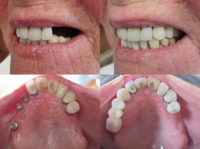 4-tooth bridge on 3 implants - Chester Mendham Dental