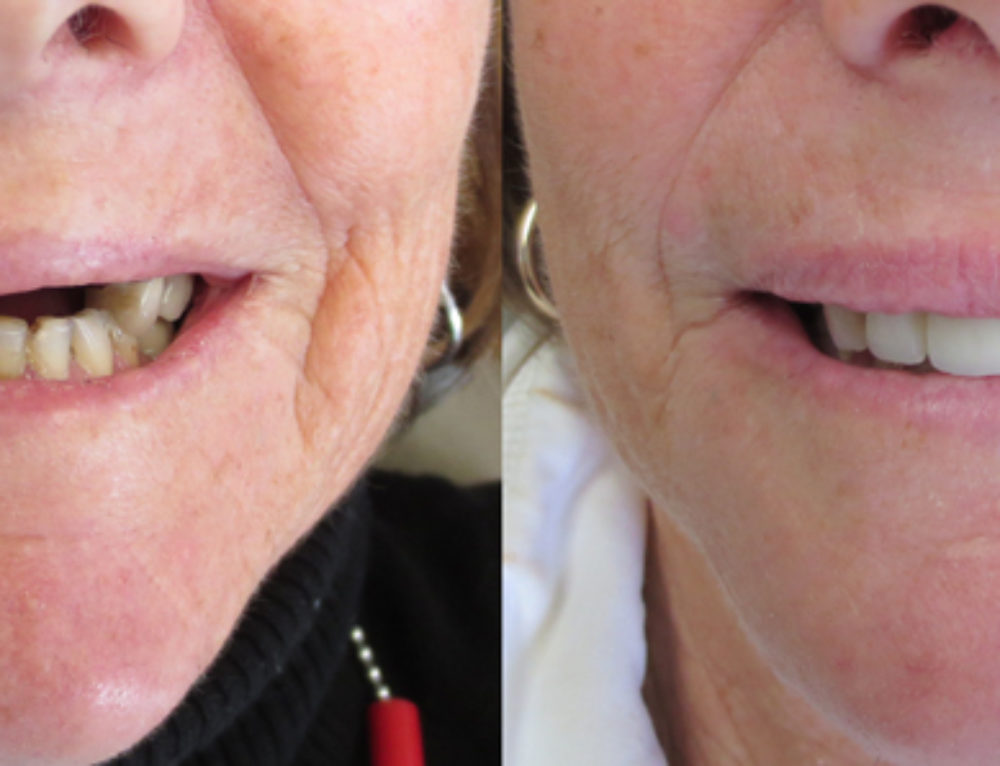 6-unit Porcelain Bridge - Chester Mendham Dental