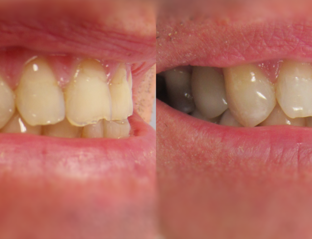 5-tooth bridge on 3 implants - Chester Mendham Dental