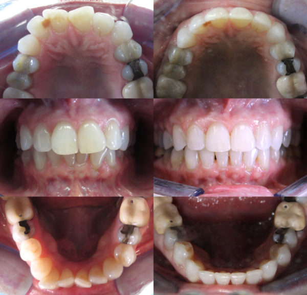 Invisalign - 52 year old female with crowding - Chester Mendham Dental