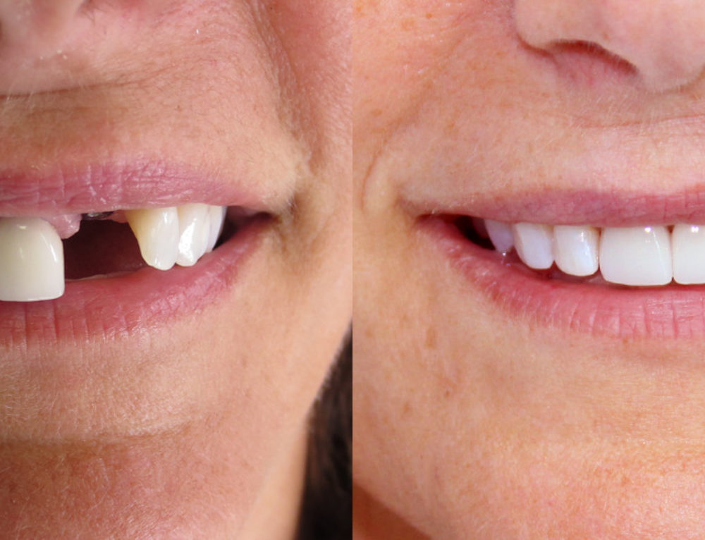 4-tooth bridge on 3 implants - Chester Mendham Dental